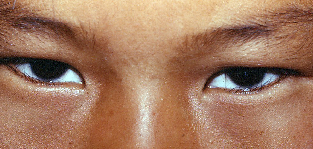 How to Remove Eyelid Fat | 7 Effective Ways (2026)