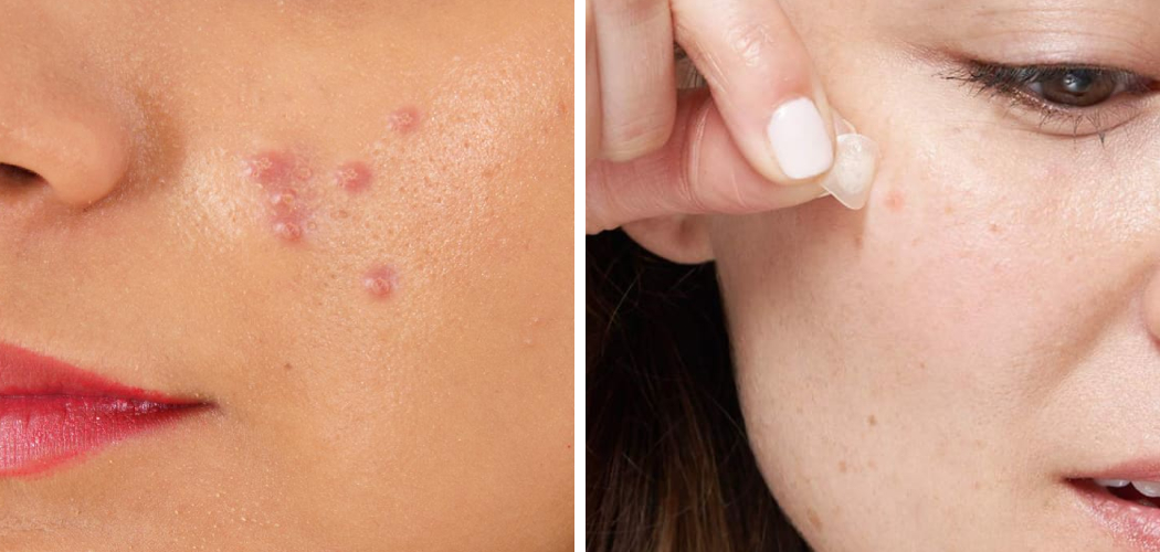 How to Cover Pimple Patch With Makeup | 10 Easy Tips (2026)