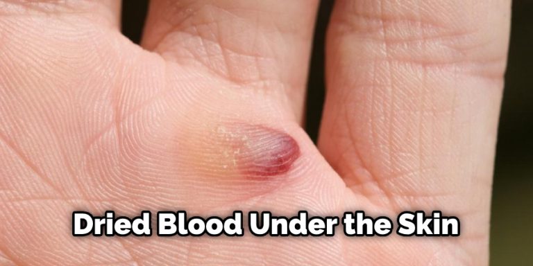 How to Get Dried Blood From Under Skin | Detailed Guide