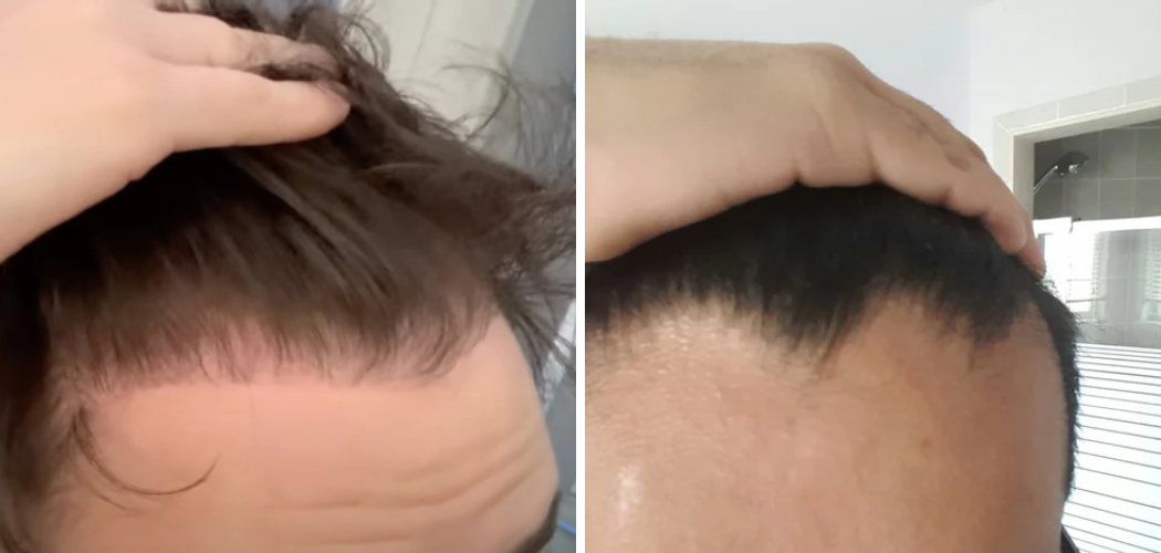 How to Fix Crooked Hairline | 10 Easy Steps (2026)